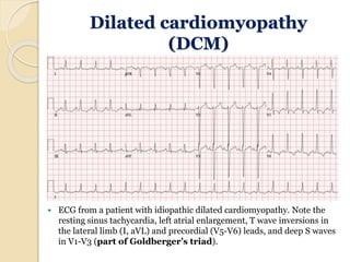 Dilated Cardiomyopathy Ecg