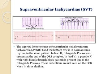 Ecg in athletes and young age | PPT