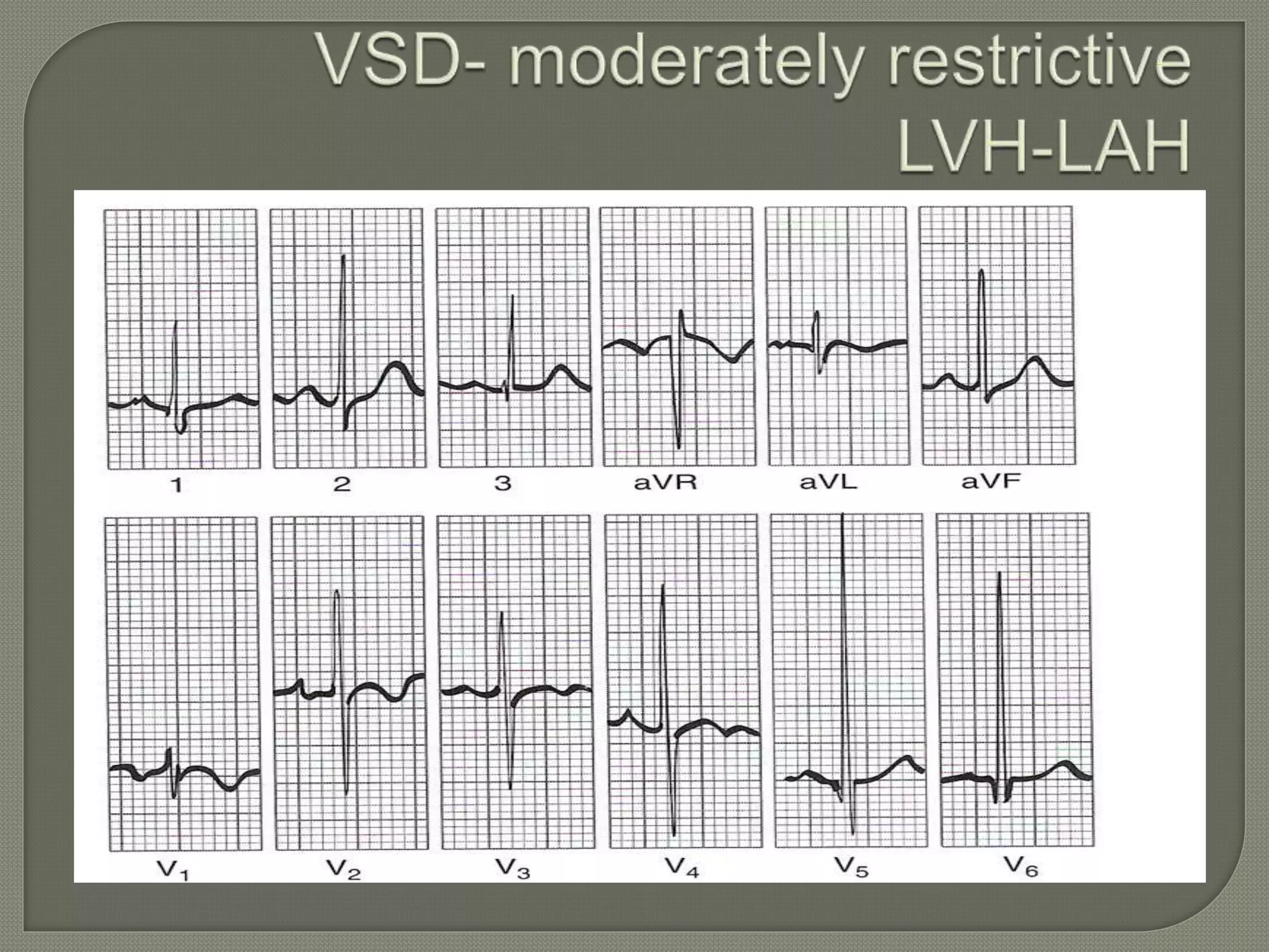 Ecg in chd presentation final | PPTX