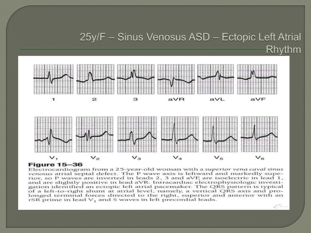 Ecg in chd presentation final | PPTX