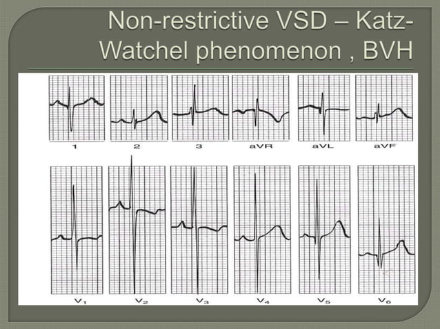 Ecg in chd presentation final | PPTX