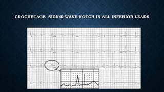 Ecg in congenital heart disease | PPTX