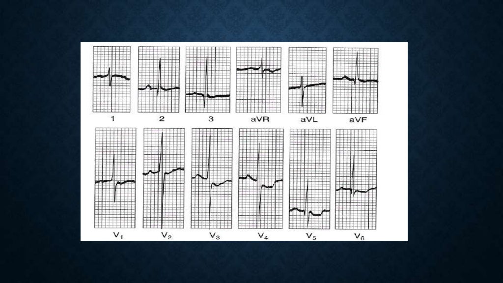 Ecg in congenital heart disease