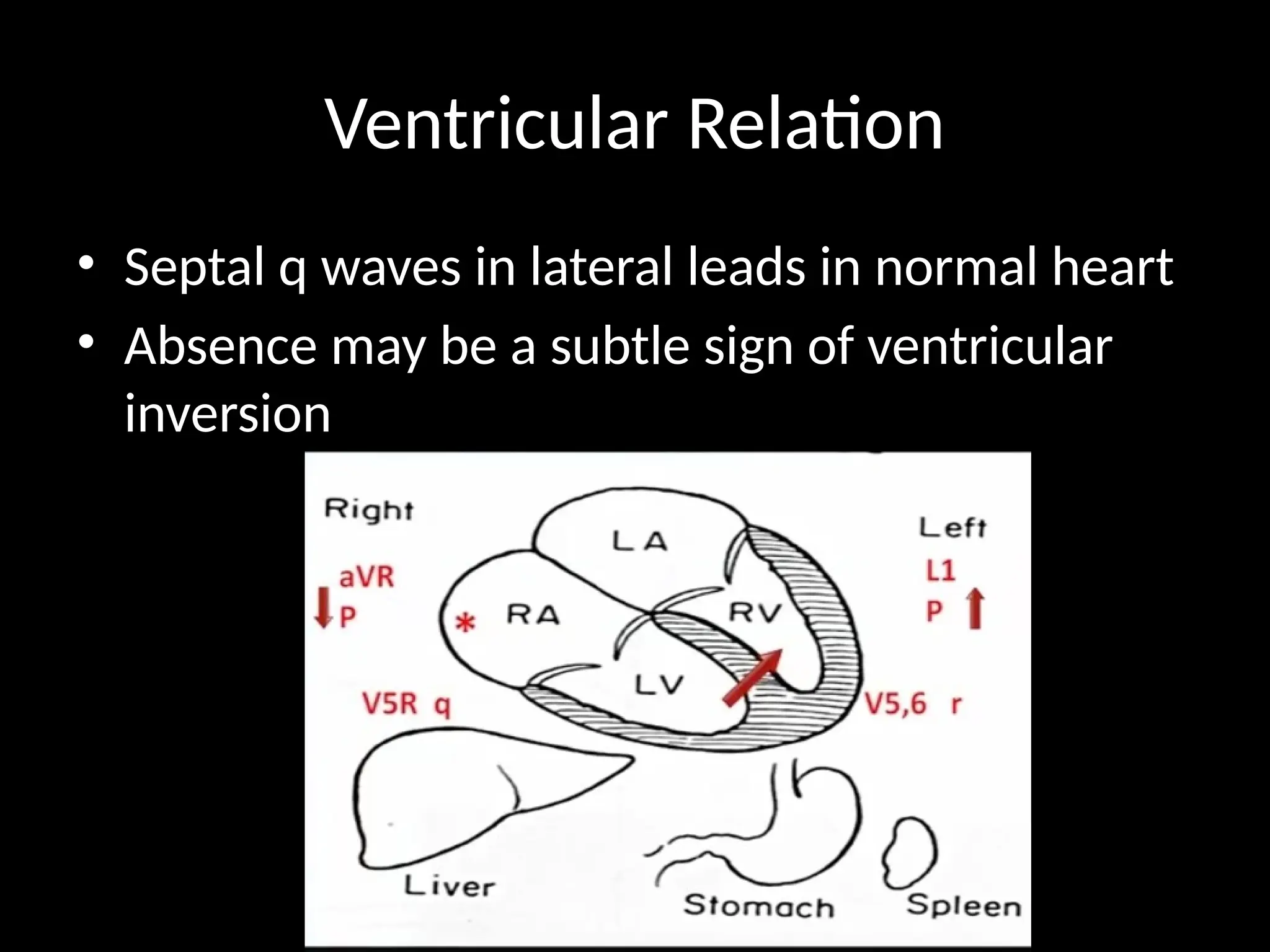 ECG IN CONGENITAL HEART DISEASE cardiology | PPTX