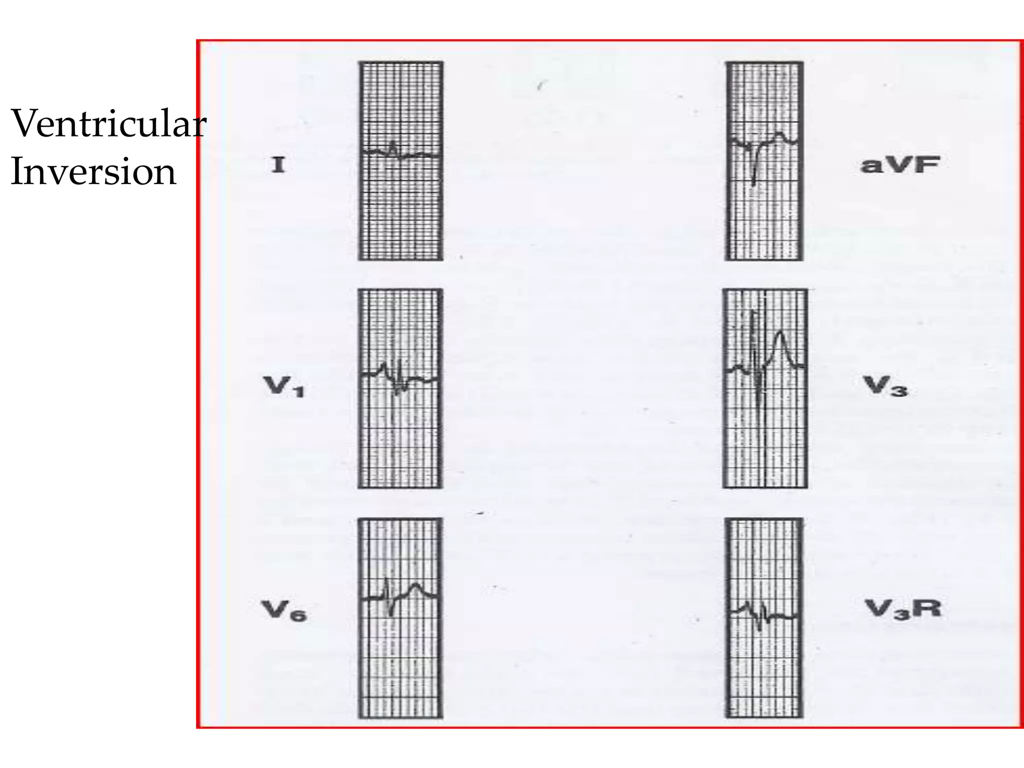 electrocardiogram (Ecg) in CONGENITAL HEART DISEASES | PPTX | Heart and ...