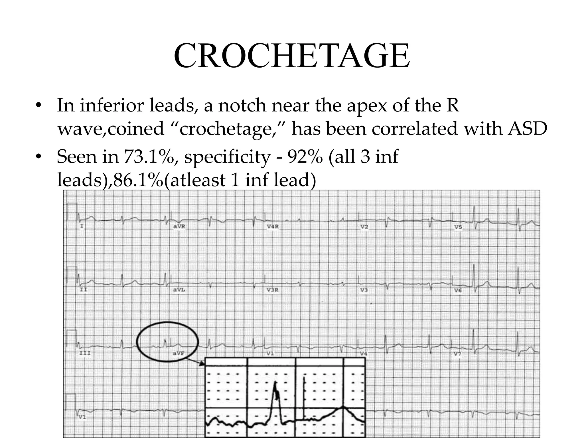 electrocardiogram (Ecg) in CONGENITAL HEART DISEASES | PPTX