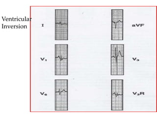 electrocardiogram (Ecg) in CONGENITAL HEART DISEASES | PPTX