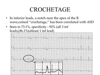 electrocardiogram (Ecg) in CONGENITAL HEART DISEASES | PPTX