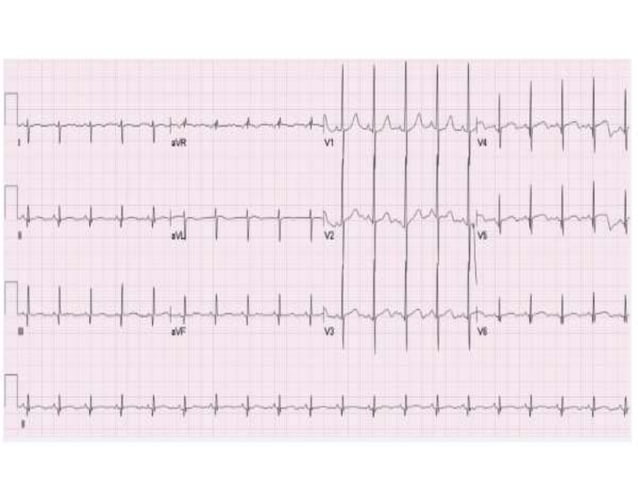 electrocardiogram (Ecg) in CONGENITAL HEART DISEASES | PPTX | Heart and ...