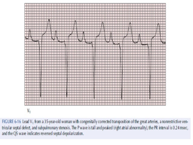 electrocardiogram (Ecg) in CONGENITAL HEART DISEASES