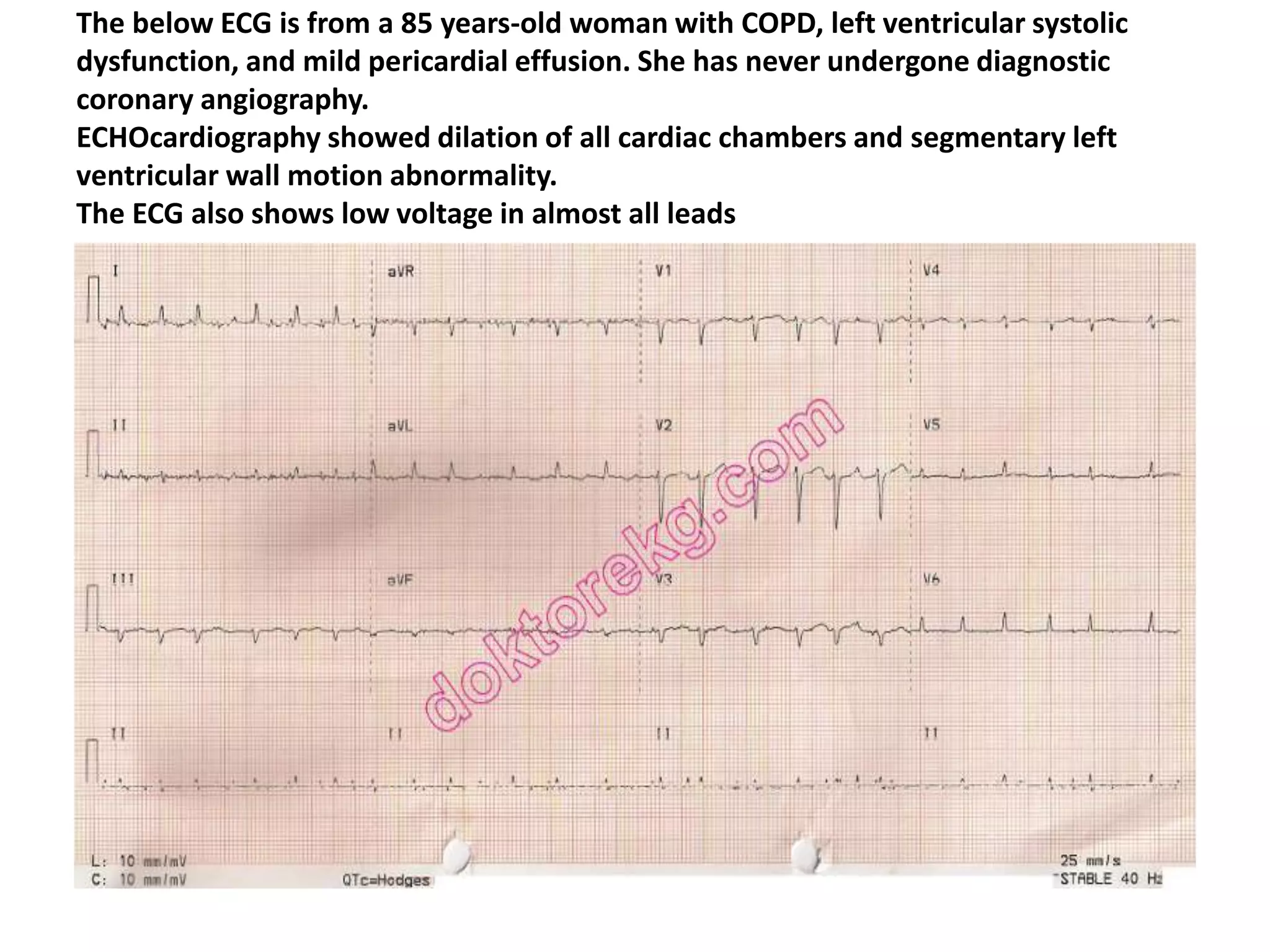 ECG/EKG changes in COPD | PPTX