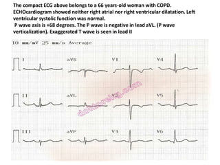 ECG/EKG changes in COPD | PPTX