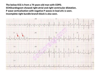 ECG/EKG changes in COPD | PPTX