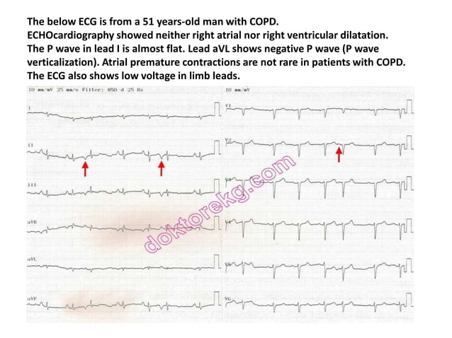ECG/EKG changes in COPD | PPTX
