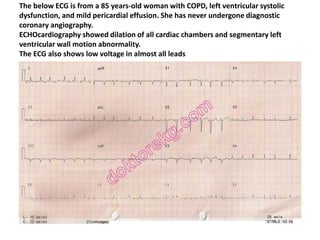 ECG/EKG changes in COPD | PPTX