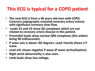 ECG/EKG changes in COPD | PPTX