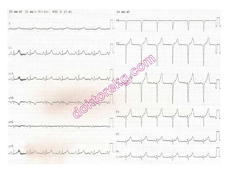 ECG/EKG changes in COPD | PPTX