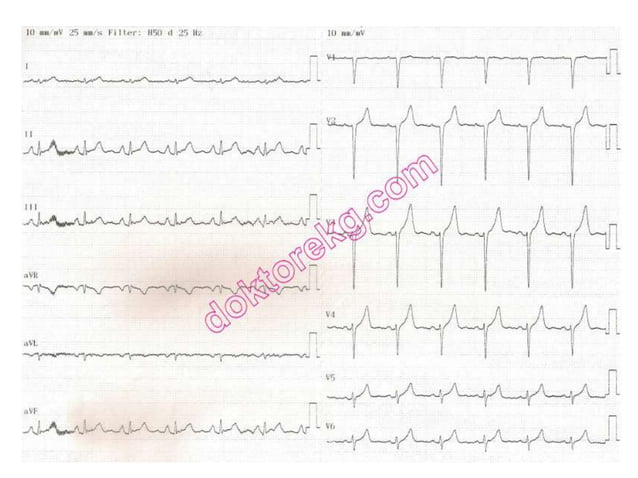 ECG/EKG changes in COPD | PPTX