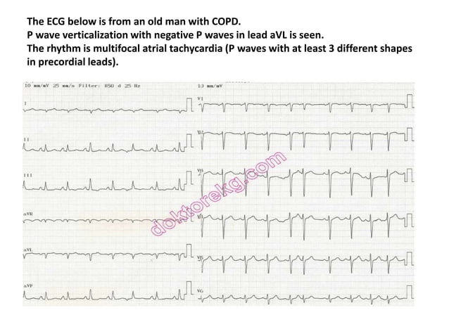 ECG/EKG changes in COPD | PPT