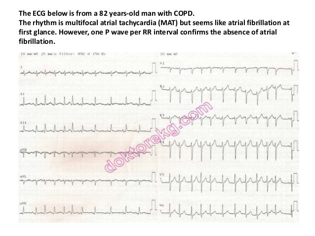 ECG/EKG changes in COPD