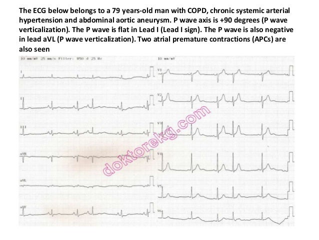 ECG/EKG changes in COPD