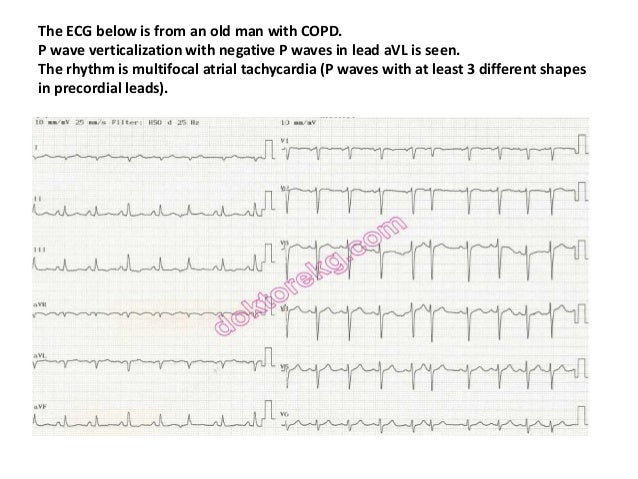 ECG/EKG changes in COPD