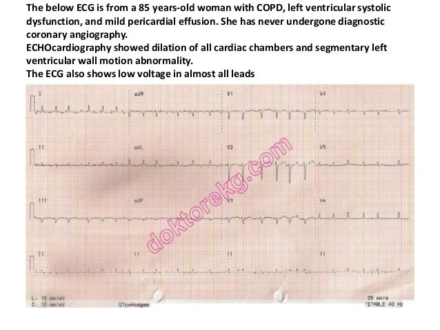 ECG/EKG changes in COPD