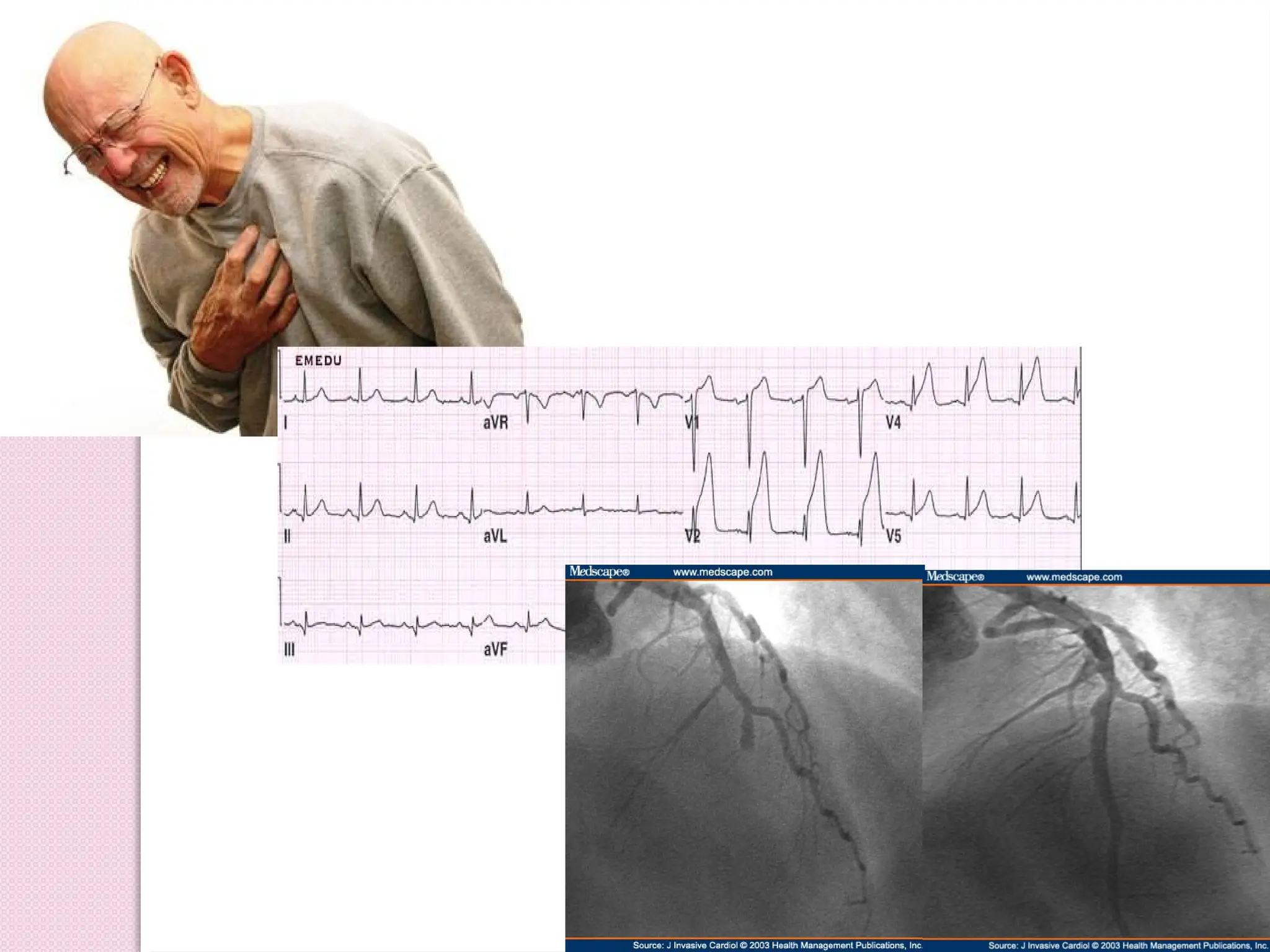 Different ECGs interpretation in Emergency | PPTX