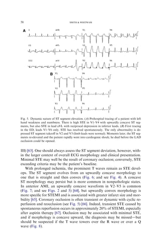 MWEBAZA VICTOR - ECG in Emergency Medicine.pdf