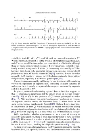 MWEBAZA VICTOR - ECG in Emergency Medicine.pdf