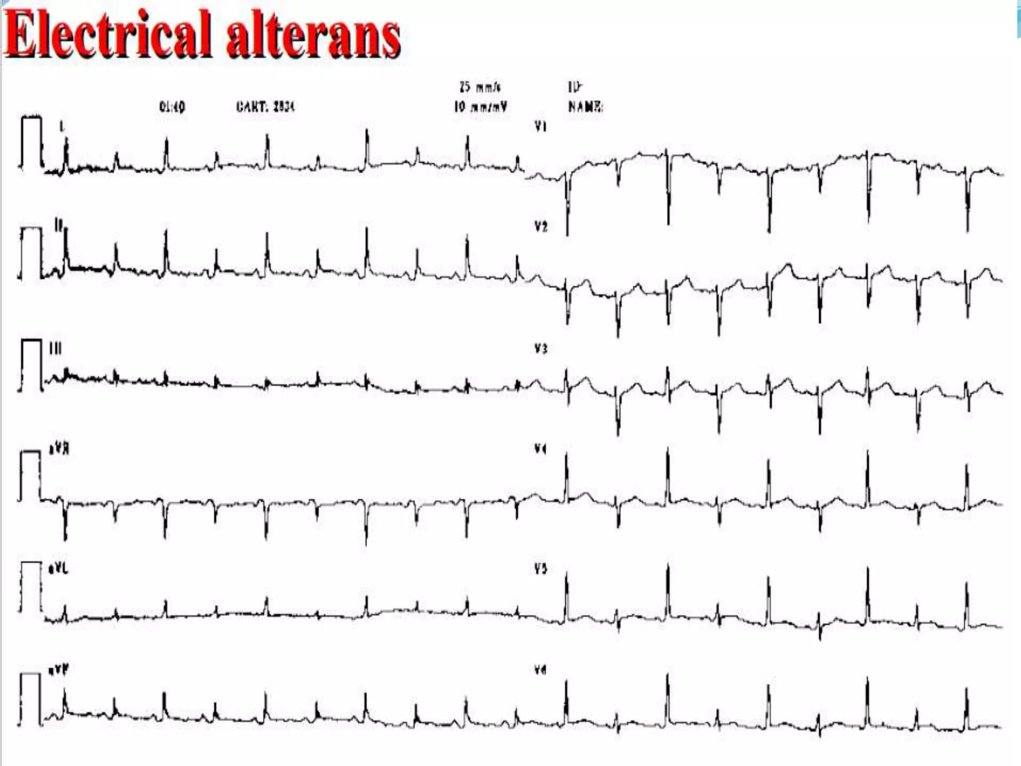 Ecg in emergency room | PPTX