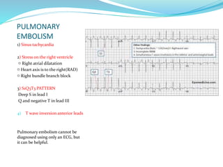 Ecg in emergency room | PPTX