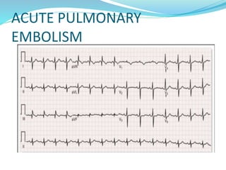 Ecg in emergency room | PPTX