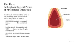 ECG of Myocardial Infarction- Evolution.pptx