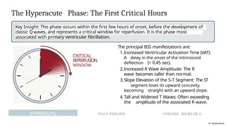 ECG of Myocardial Infarction- Evolution.pptx