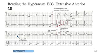 ECG of Myocardial Infarction- Evolution.pptx