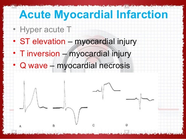 Ecg In Ischemic Heart Disease