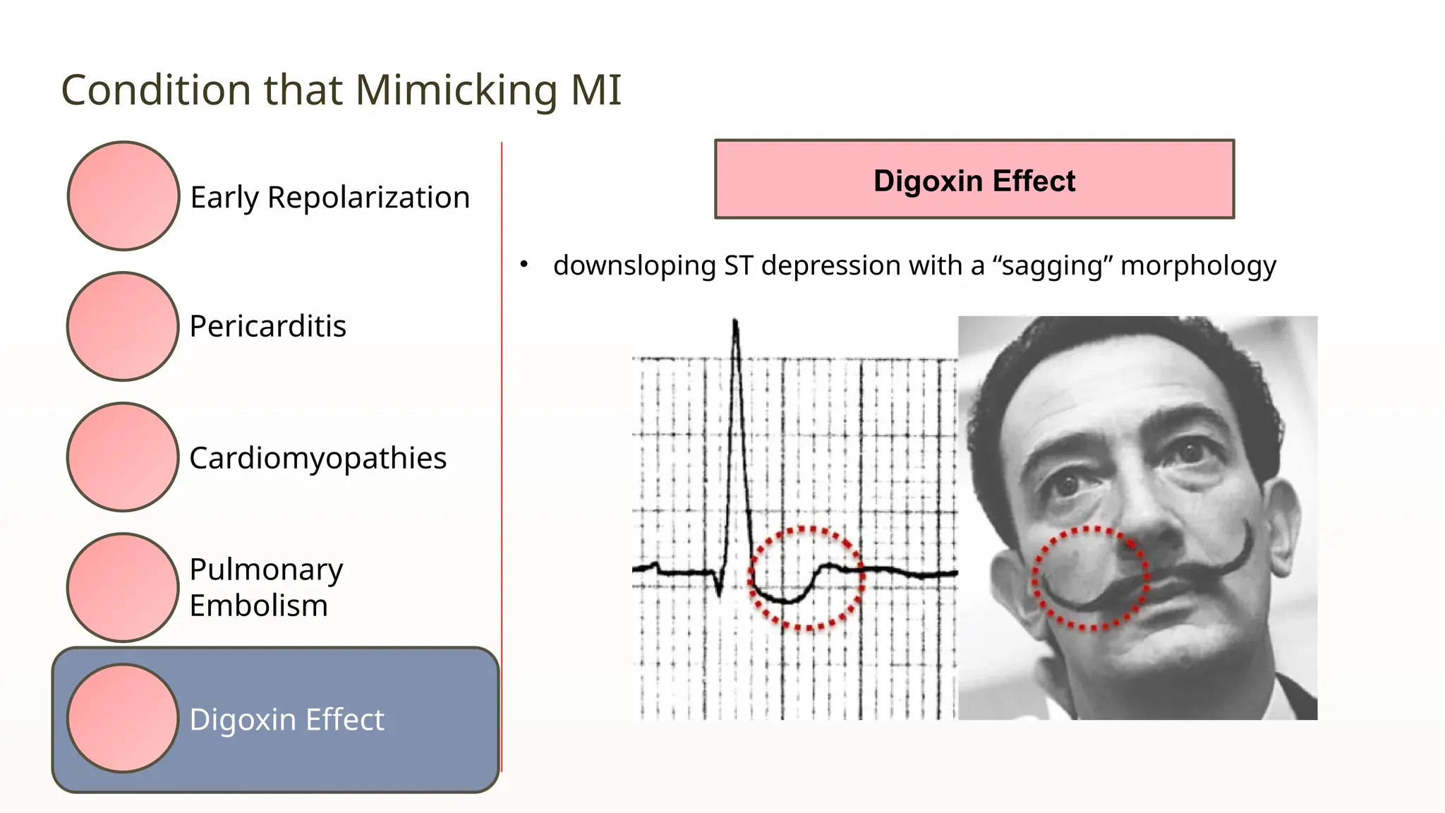 ECG in Ischemia Heart Disease RSMWM.pptx
