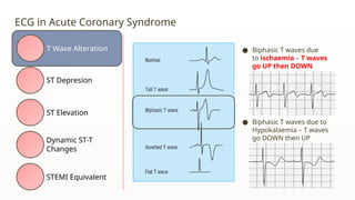 ECG in Ischemia Heart Disease RSMWM.pptx