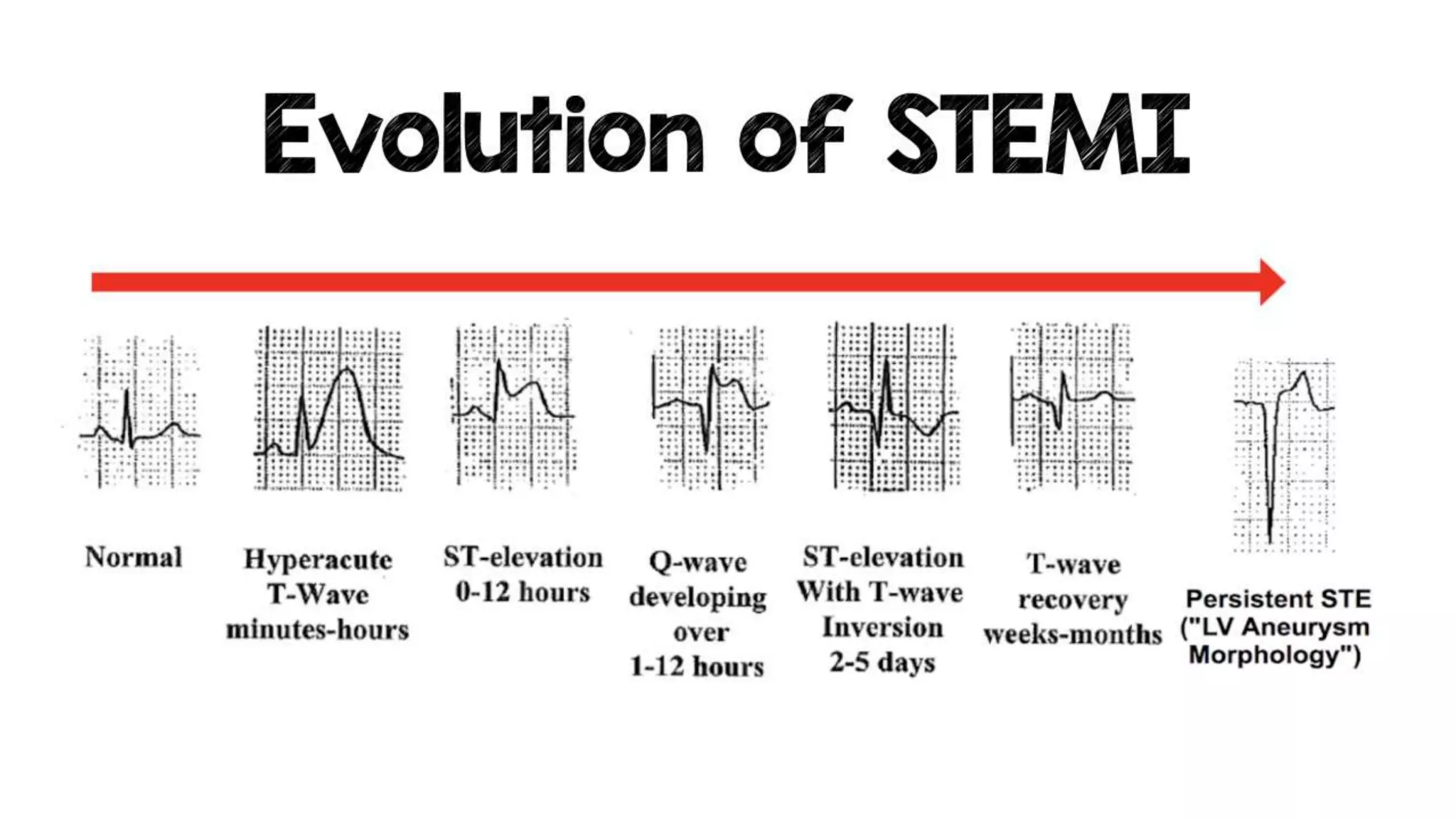 ECG in MI.pptx
