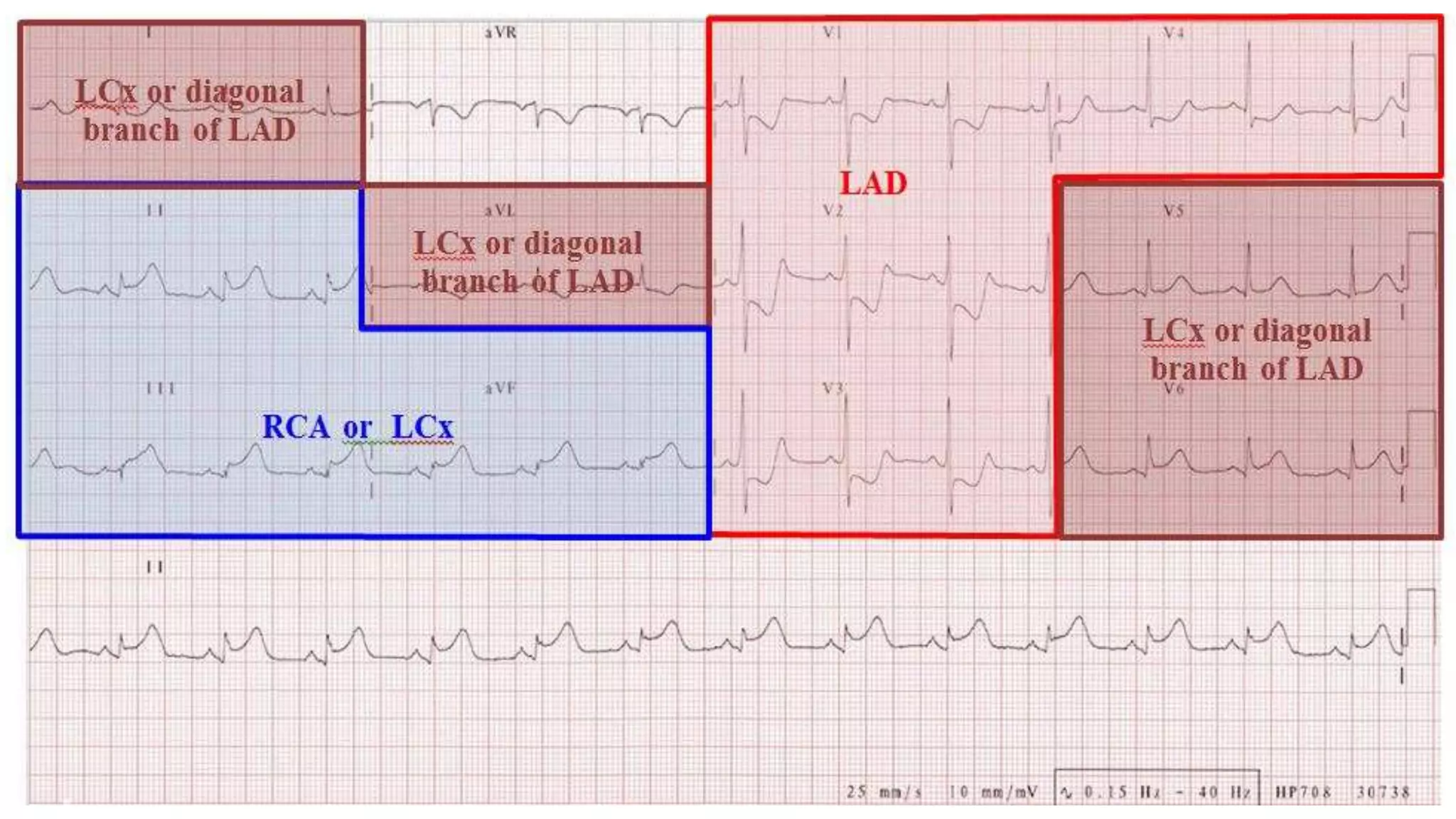 ECG in MI.pptx