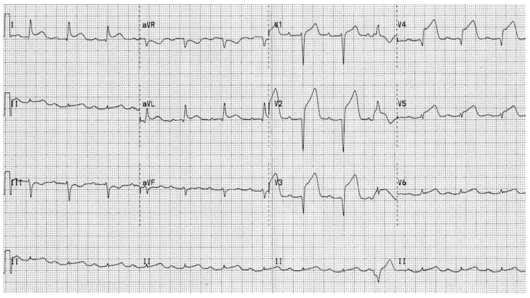 ECG in MI.pptx
