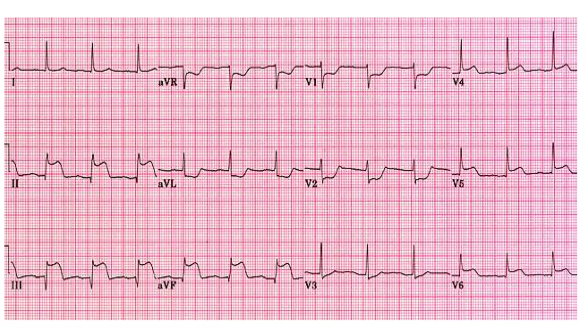 ECG in MI.pptx
