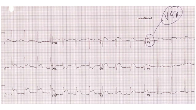 ECG in MI.pptx
