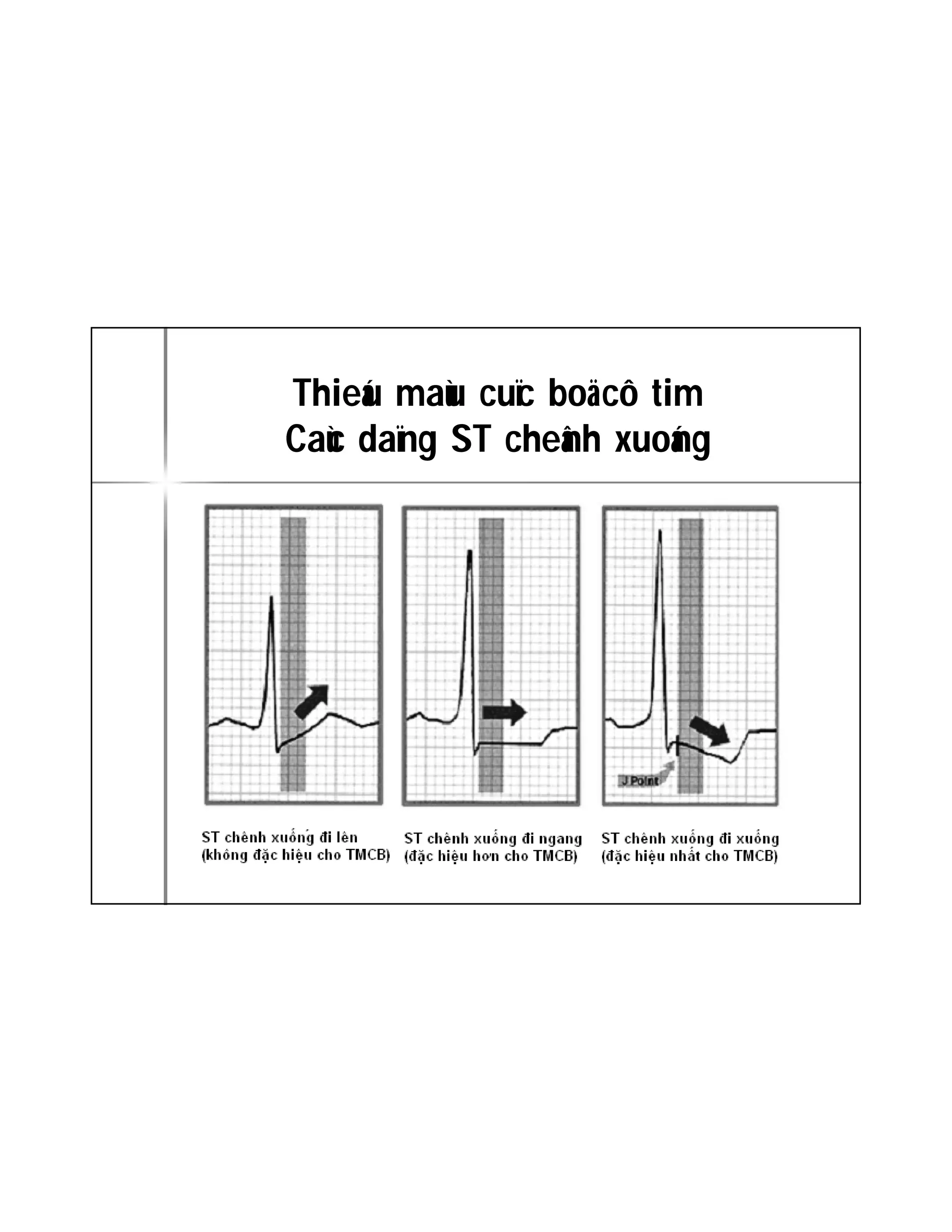 ECG TRONG NONSTEMI | PDF