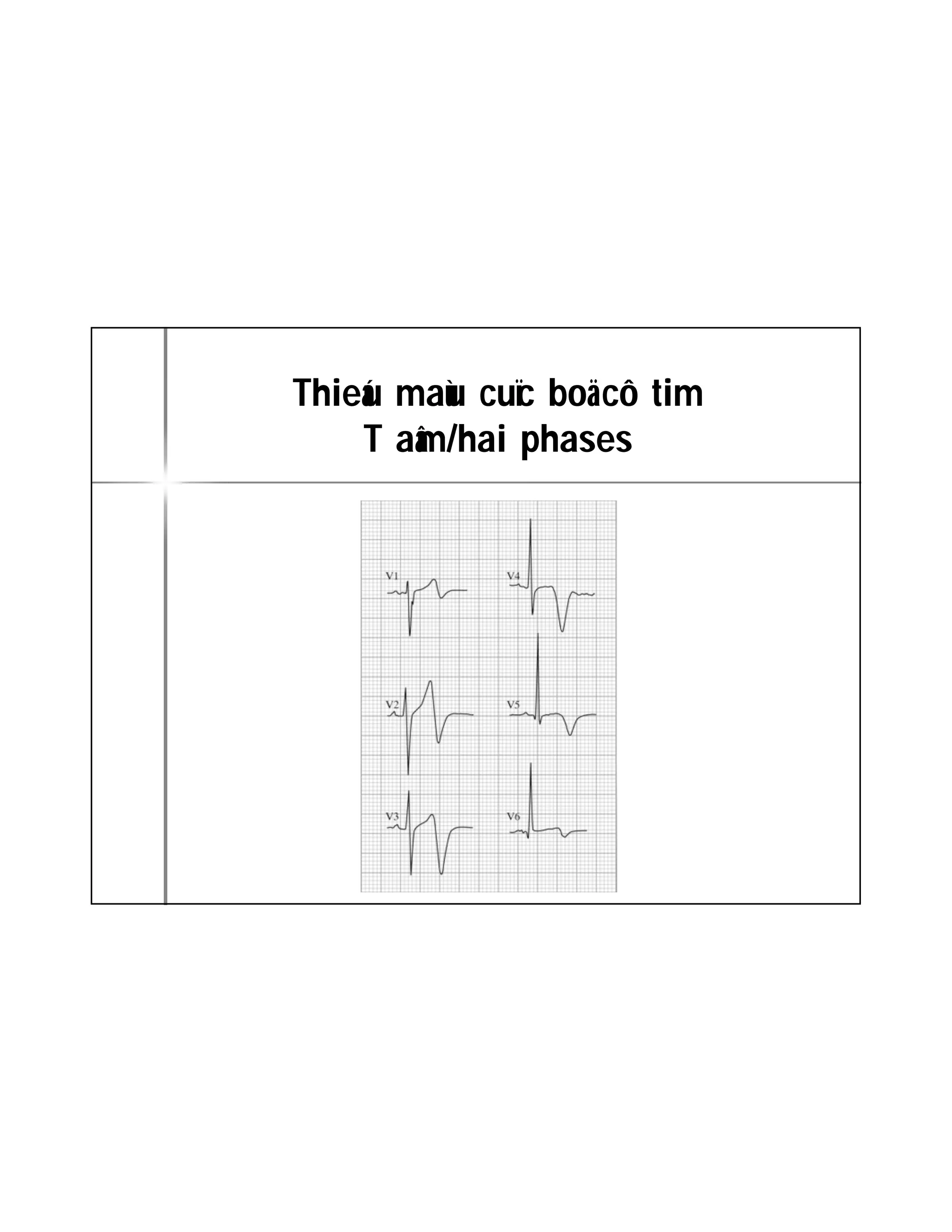 ECG TRONG NONSTEMI | PDF