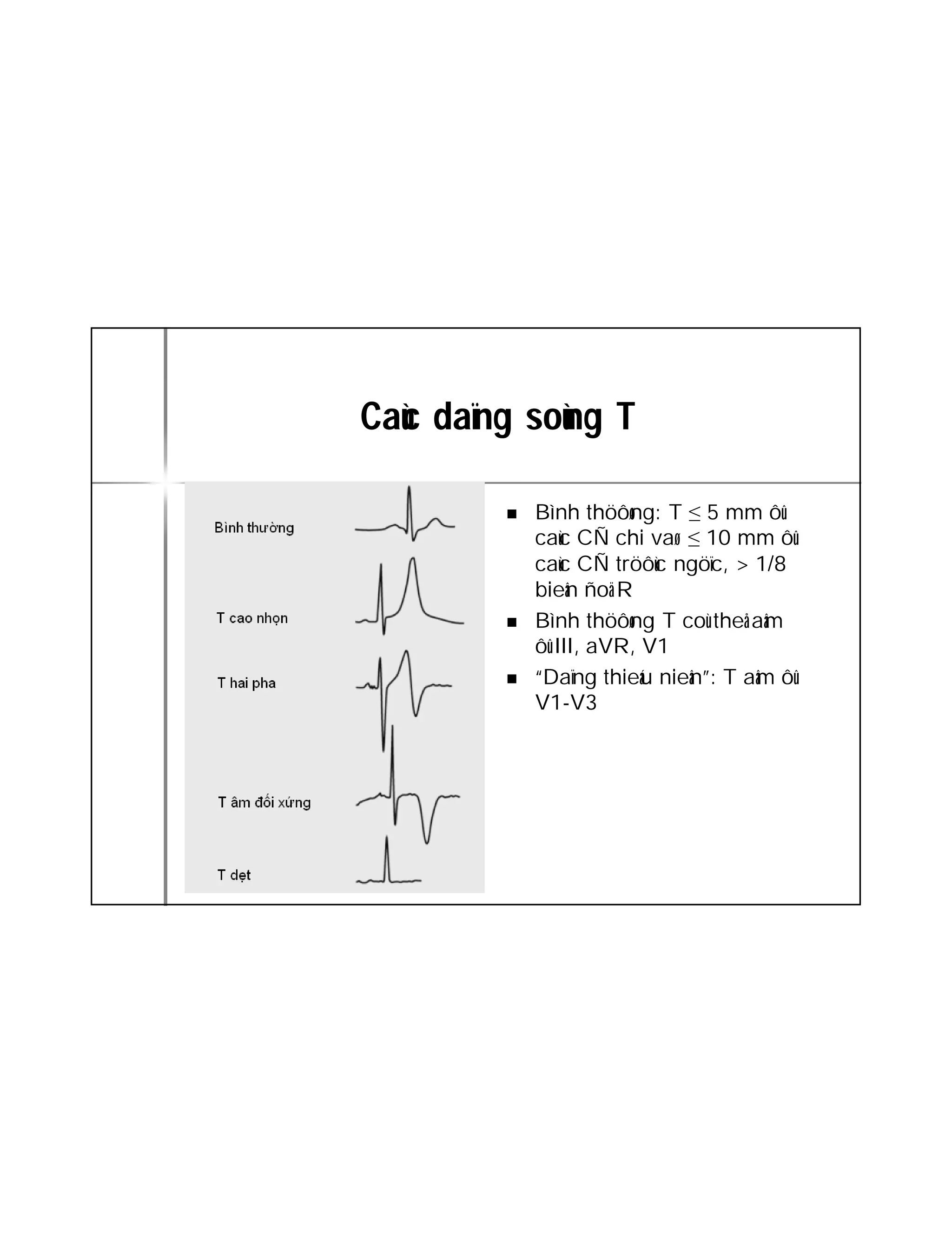 ECG TRONG NONSTEMI | PDF