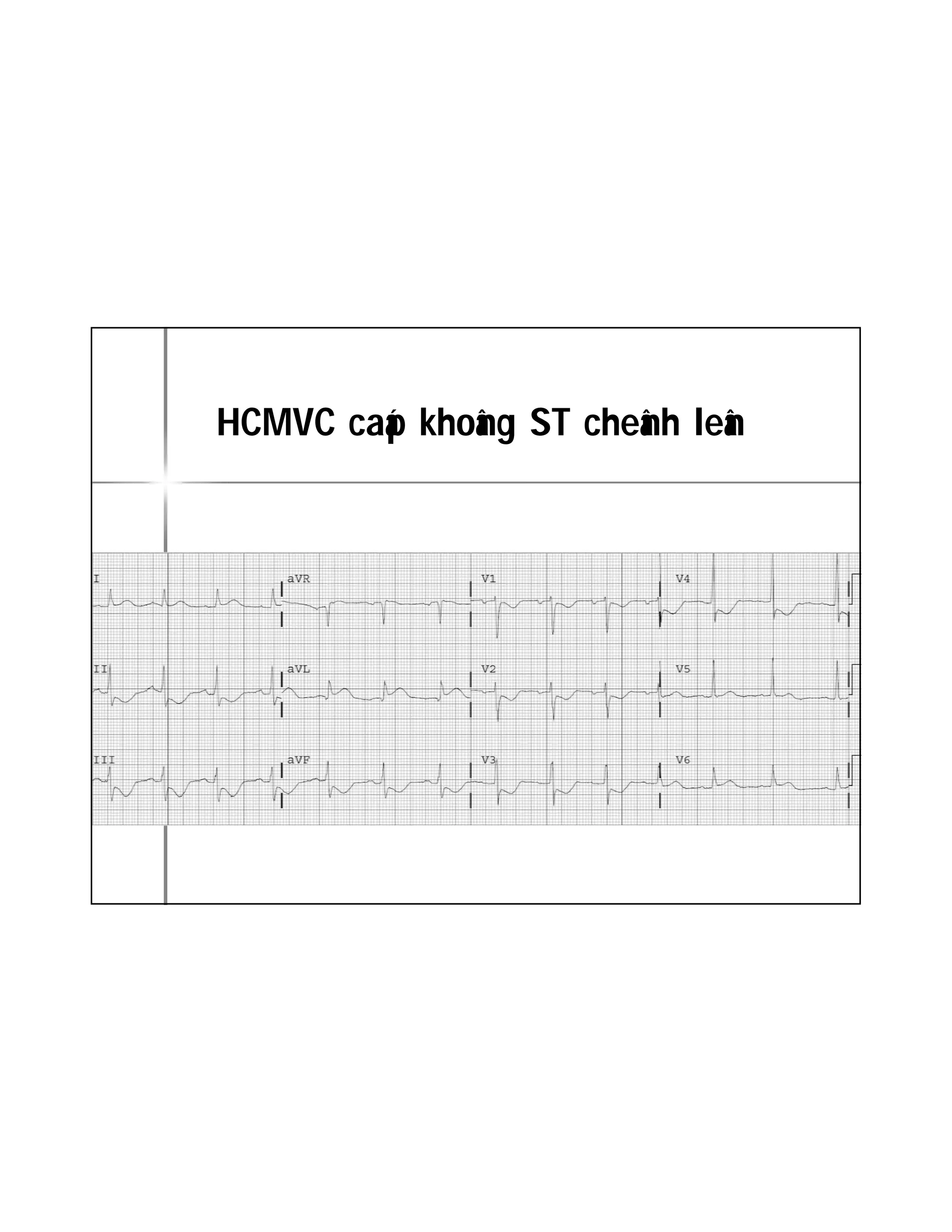 ECG TRONG NONSTEMI | PDF