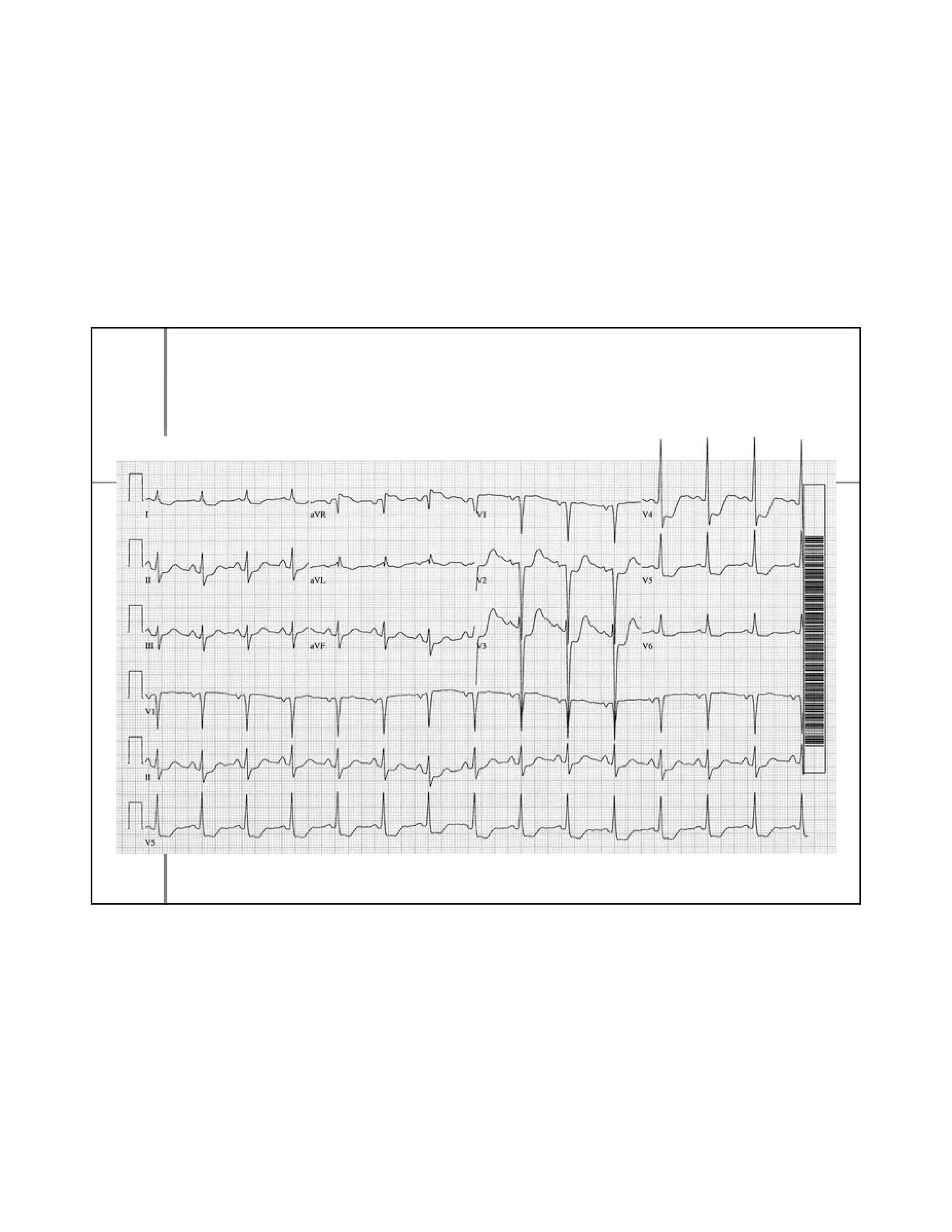 ECG TRONG NONSTEMI | PDF