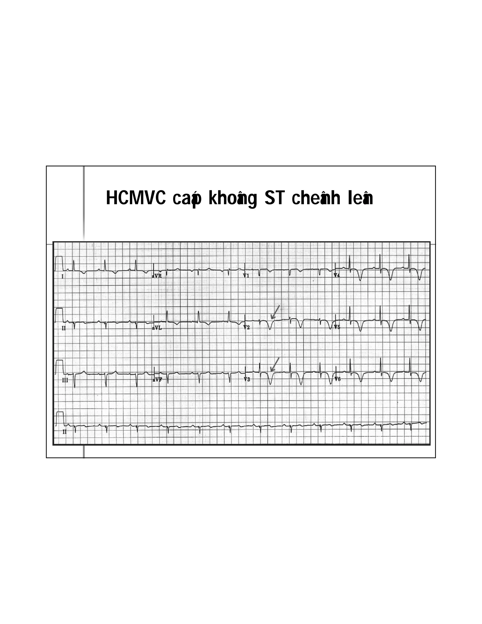 ECG TRONG NONSTEMI | PDF